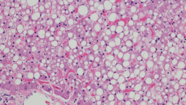 NASH Overview: Causes, Symptoms, Diagnosis, and Treatment | Pfizer