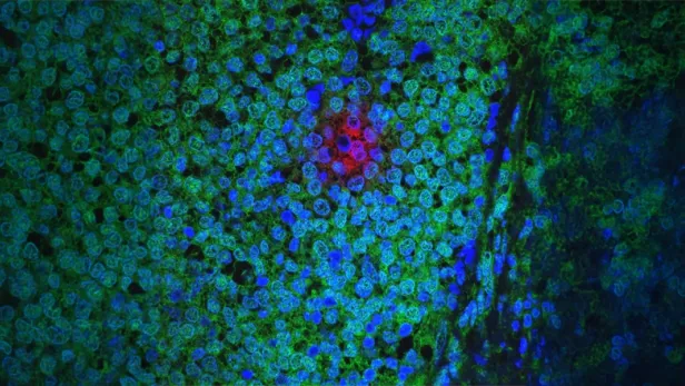 Microscopic image of breast cancer cells resisting treatment